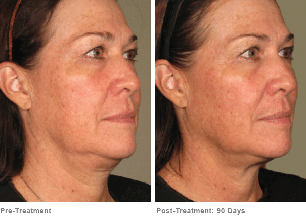 Ultherapy West Orange NJ | Skin Tightening Treatment Newark NJ